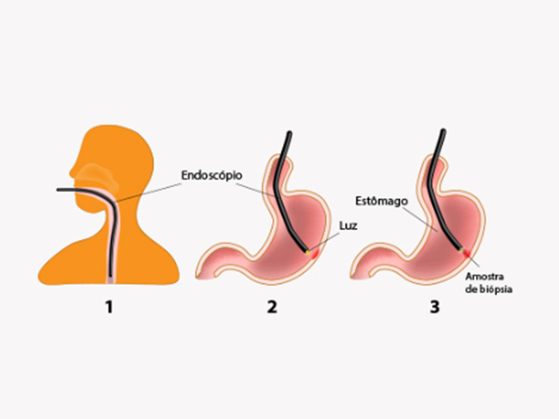 Endoscopia Digestiva Alta – Clínica Concon